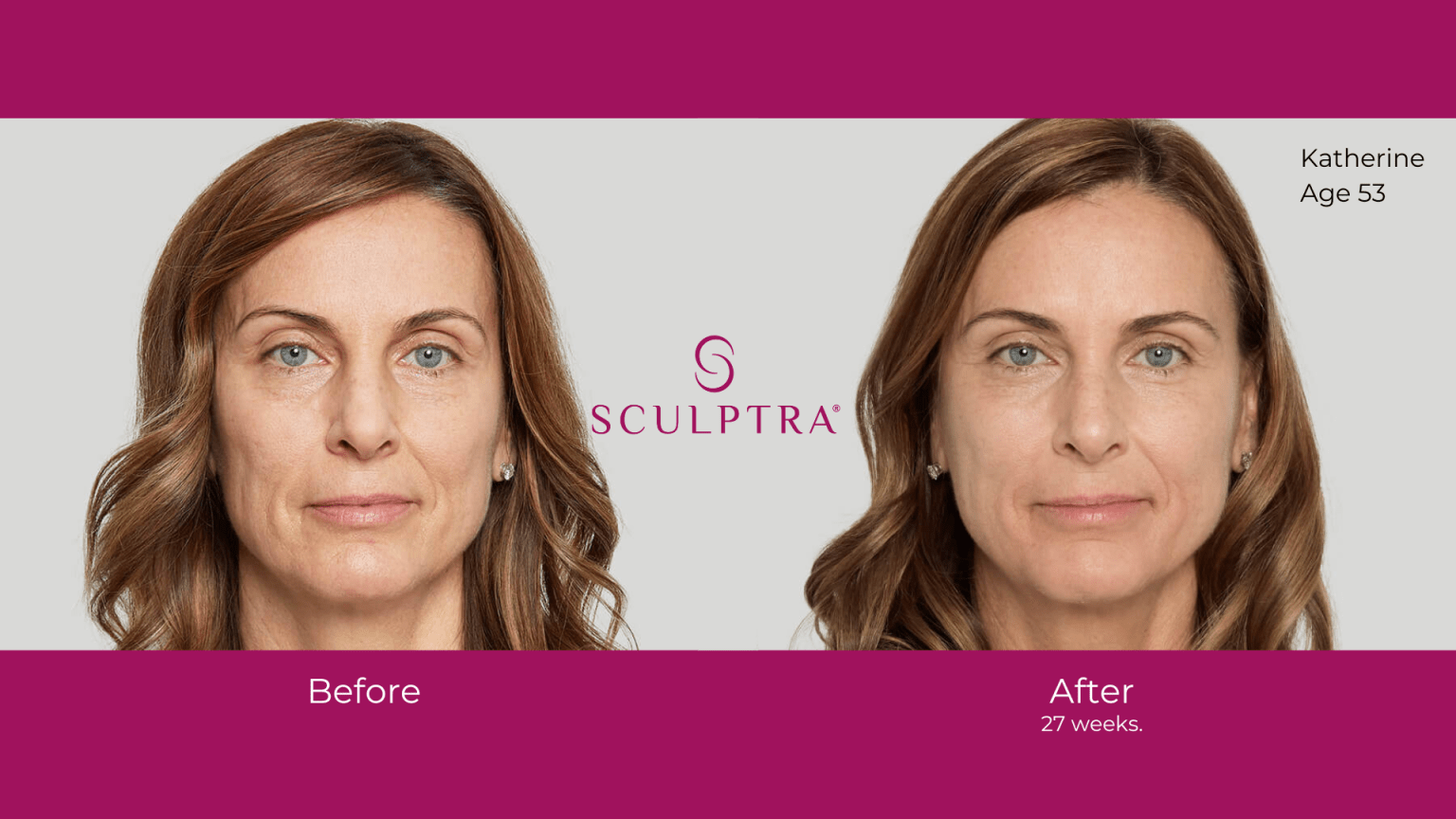 Sculptra Treatment in Kuala Lumpur & Selangor, Malaysia