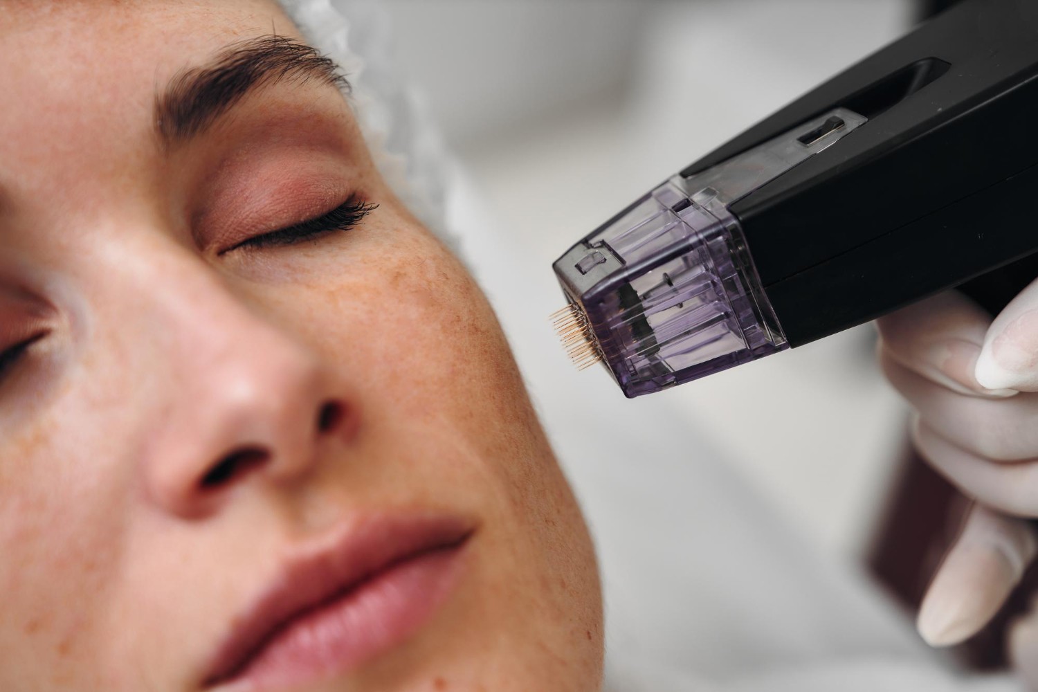 Microneedling for Acne Scars: Achieve Flawless Skin